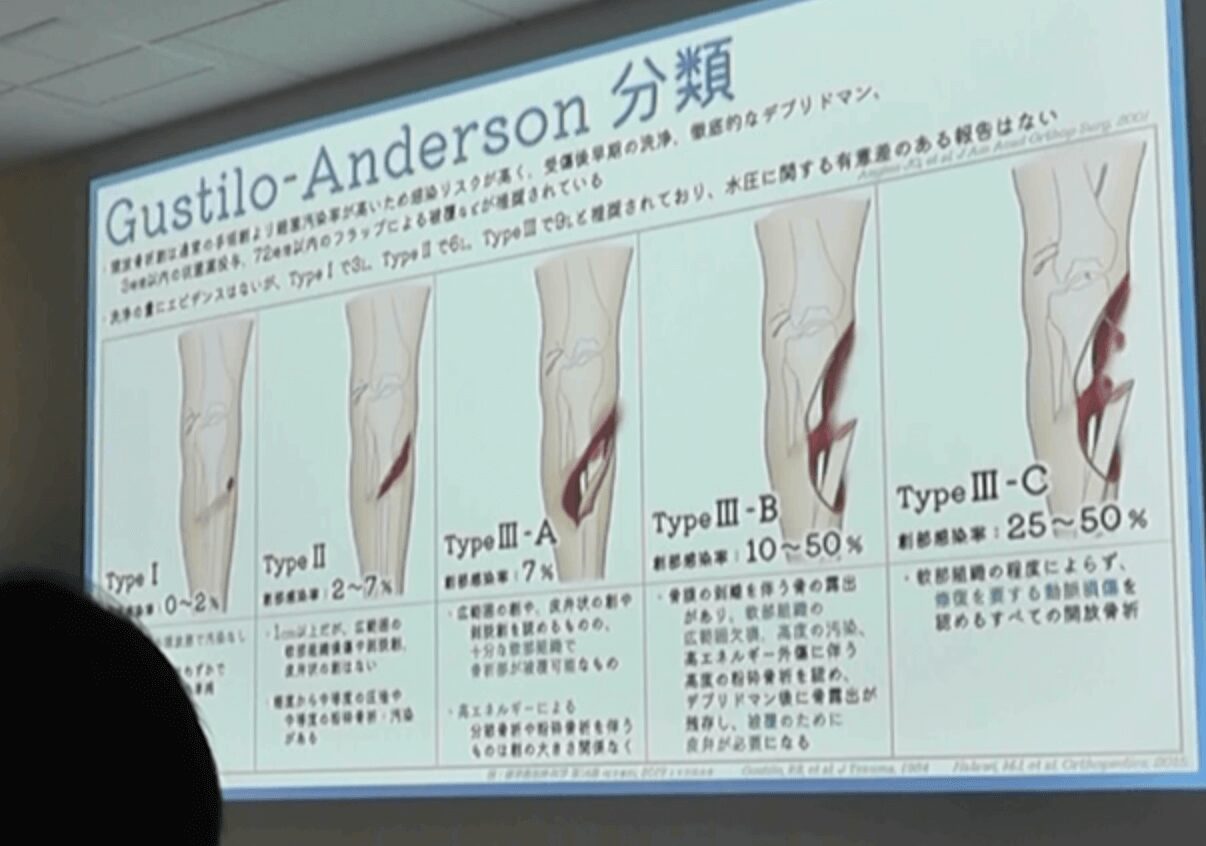 【YTTレポート】開放骨折と骨髄炎に対する抗菌薬治療 | 埼玉医大高度救命救急センター